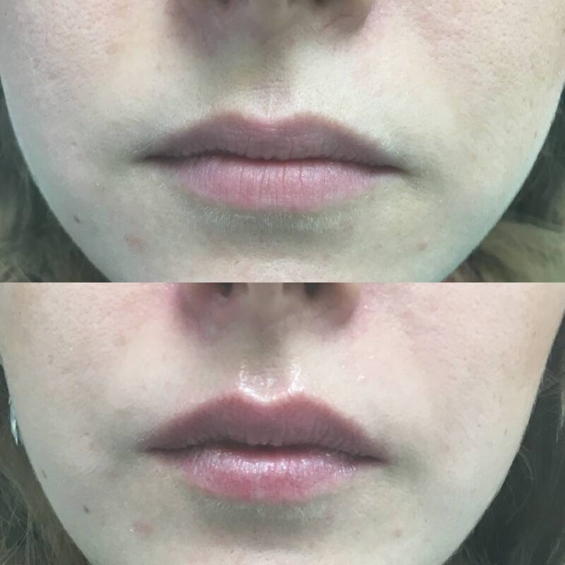 Laser Treatments | River City Cosmetic Medicine Clinic